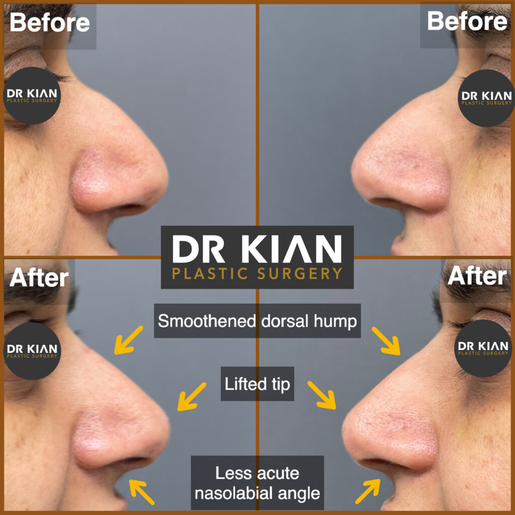 Why are some many people choosing Liquid Rhinoplasty?